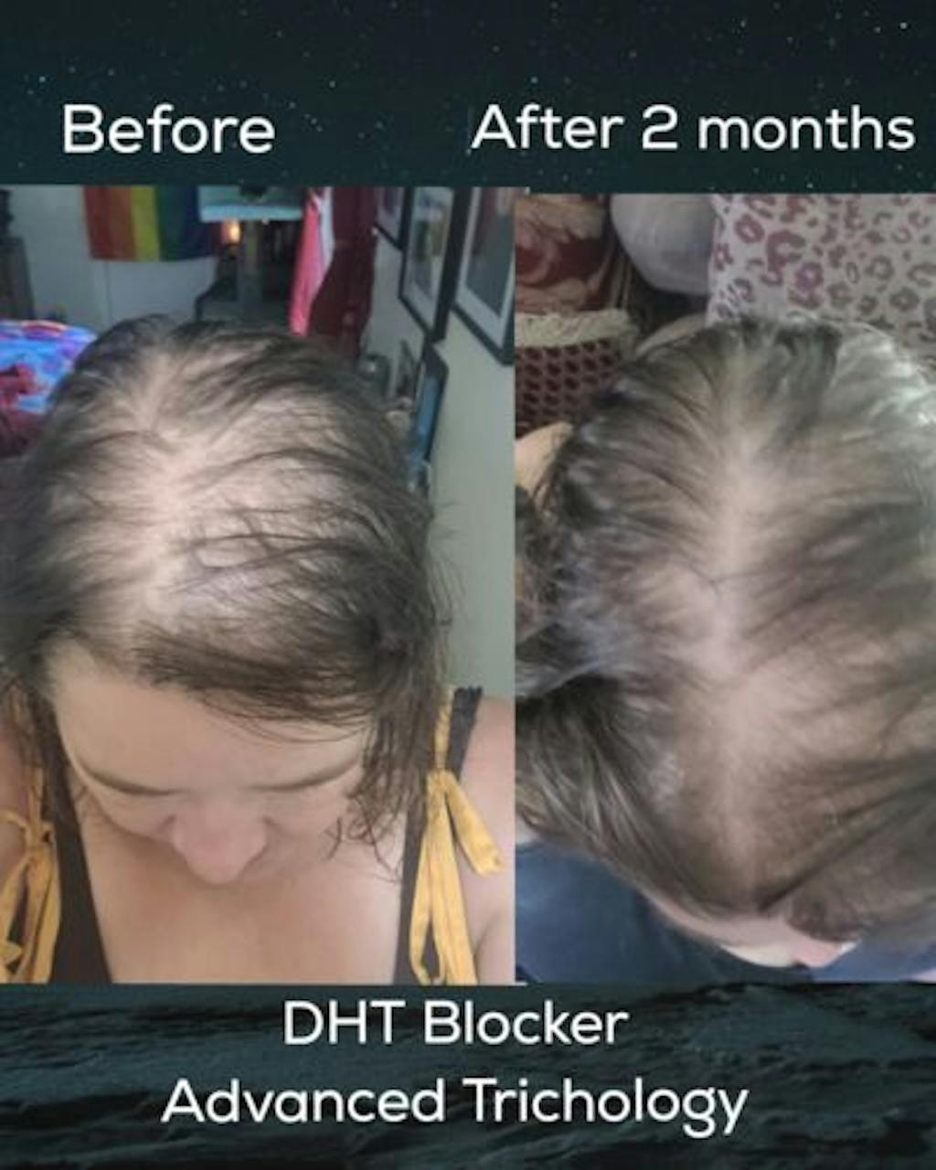 DHT Blocker Vitamin with Immune Support, Saw Palmetto, and Green Tea ...