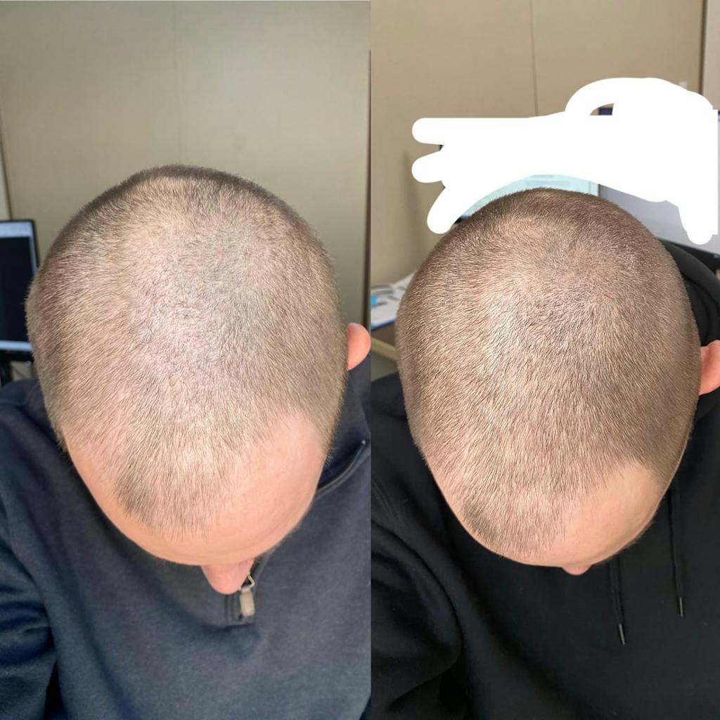 AlphaInfuse Hair Regrowth Micro-Infusion System For Men - Regrow ...