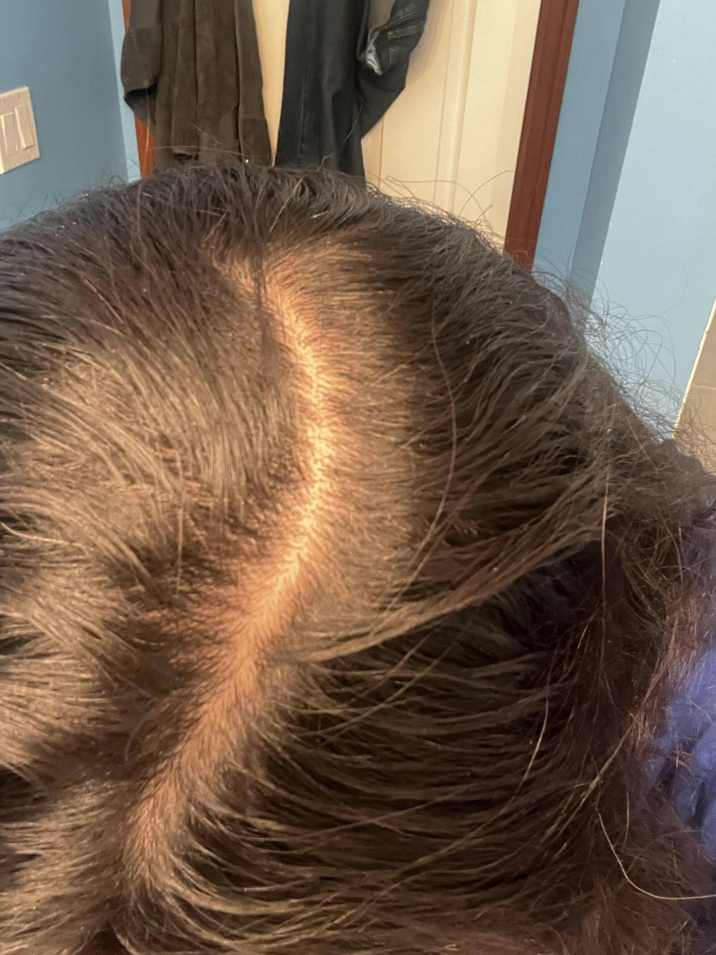 AMAZING HAIR SAVIOUR & AMAZING SCALP SAVIOUR COMBO – Amazing Hair Saviour