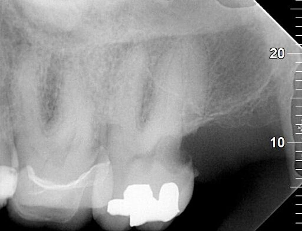 Xpanders™ | Dental Elevator Tool | Elevator for Tooth Extraction