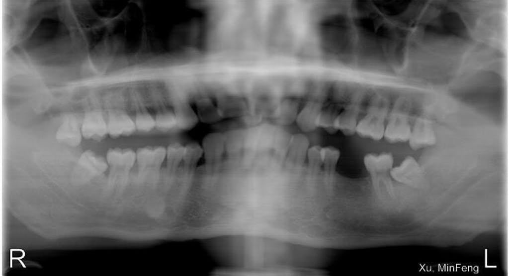 Xpanders™ | Dental Elevator Tool | Elevator for Tooth Extraction