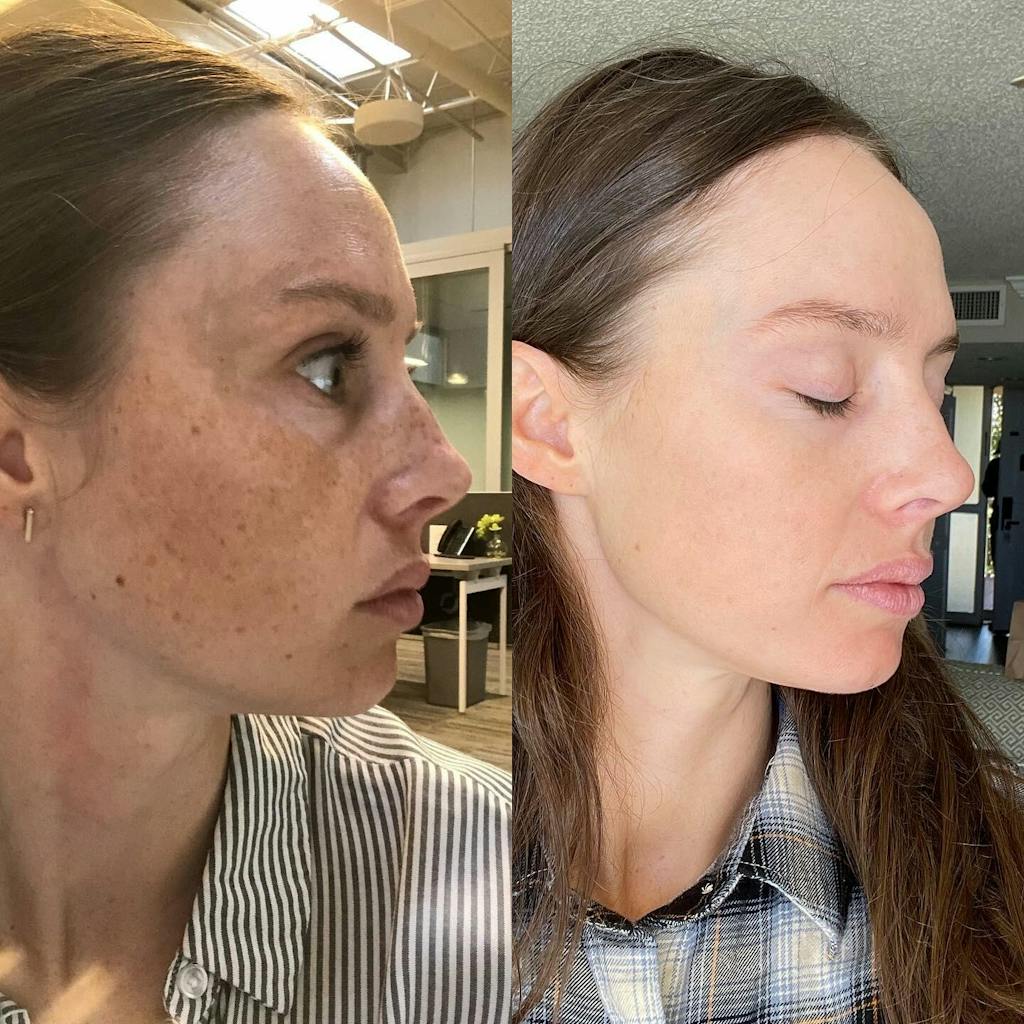 Artemis LED Mask & Neck System