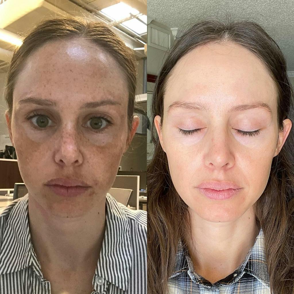 Artemis LED Mask & Neck System