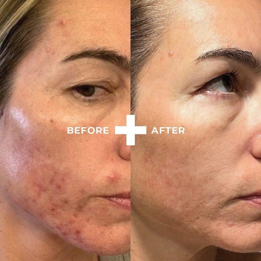 Artemis LED Mask & Neck System