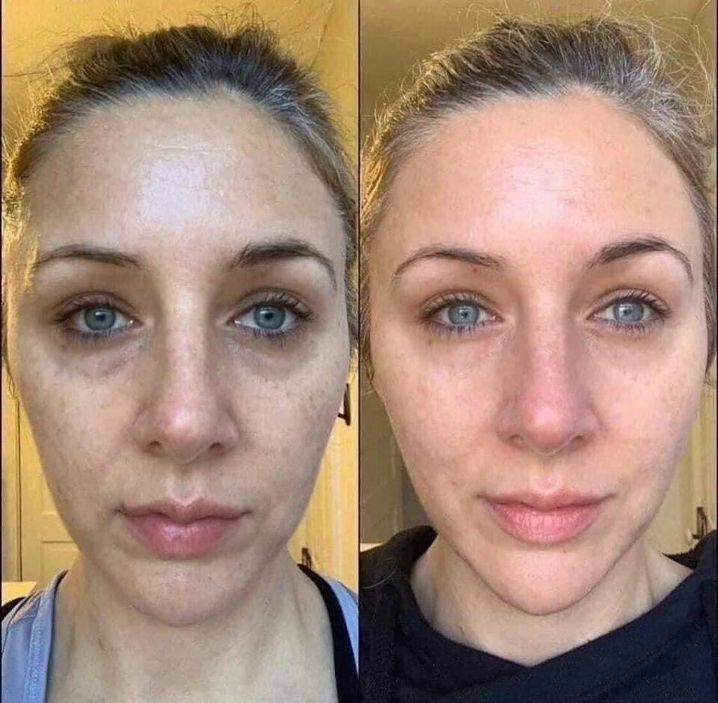 Artemis LED Mask & Neck System