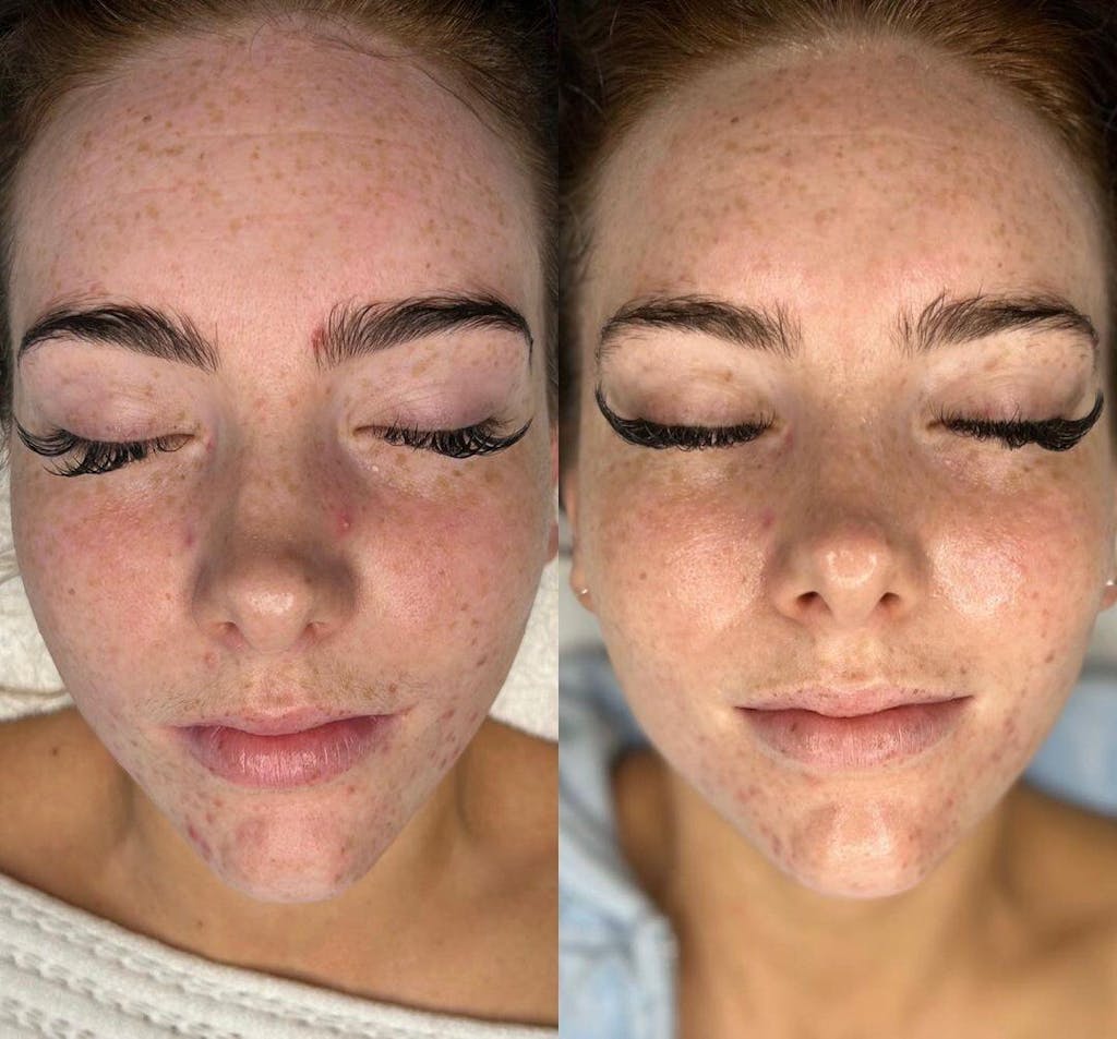 Artemis LED Complete System