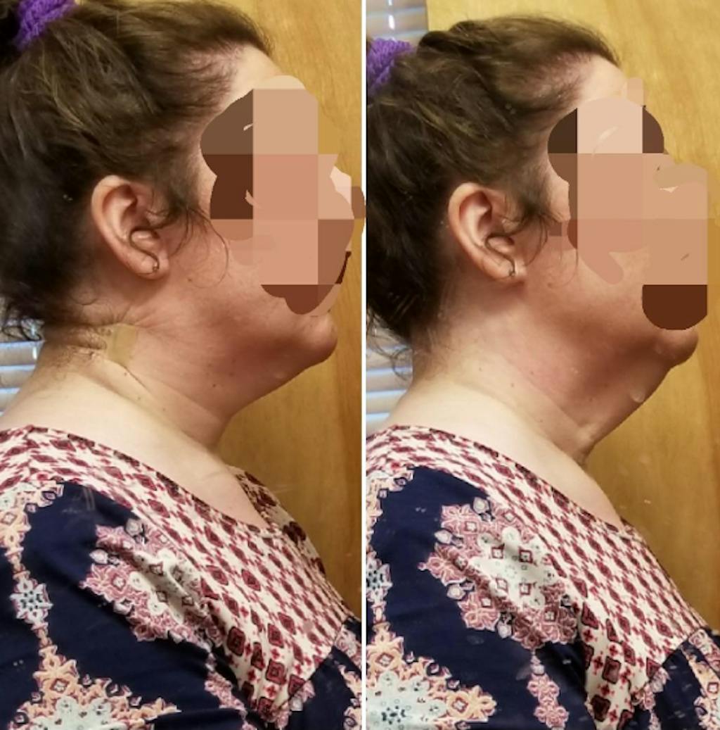 The Instant Neck Lift l No Pain Neck Lift Stretch Bands – Balma Home