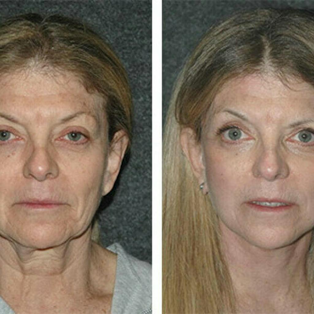 The Instant Neck Lift l No Pain Neck Lift Stretch Bands – Balma Home