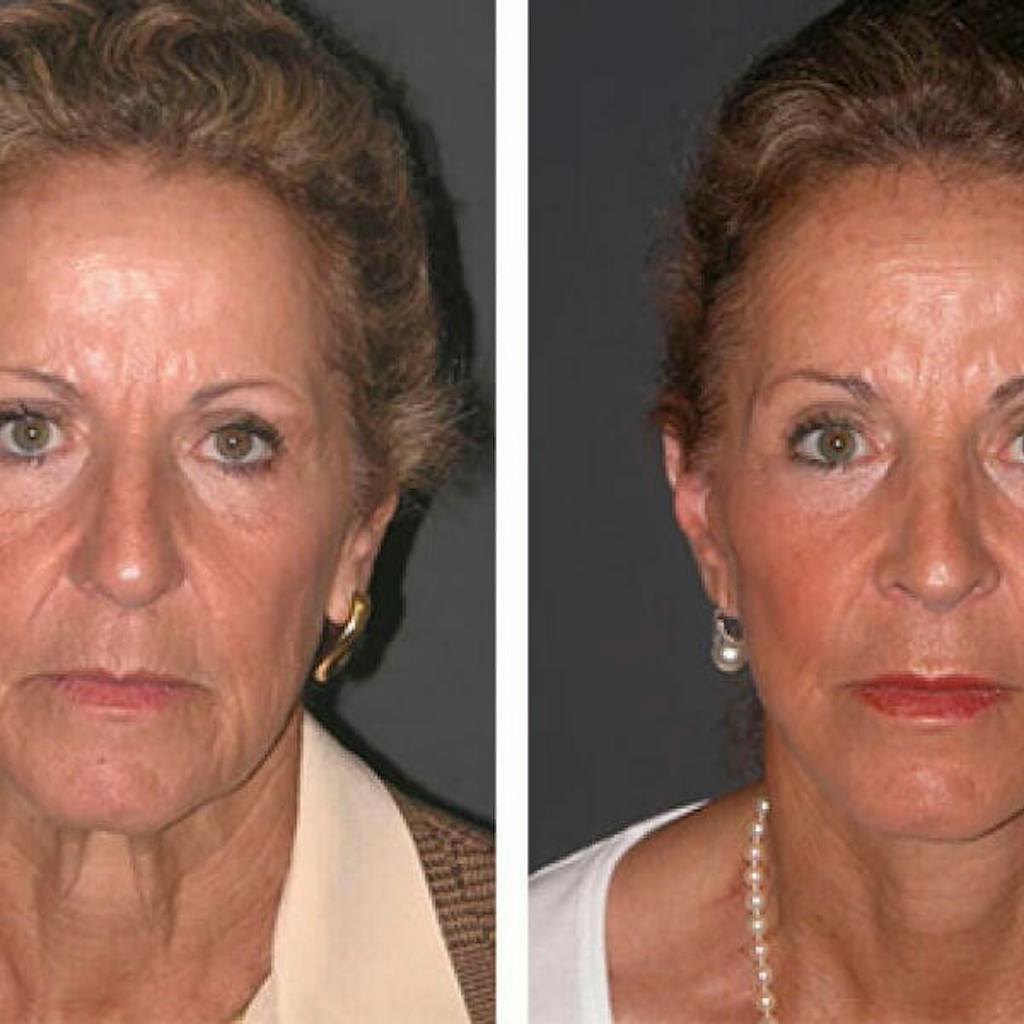 The Instant Neck Lift l No Pain Neck Lift Stretch Bands – Balma Home