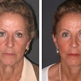 The Instant Neck Lift l No Pain Neck Lift Stretch Bands – Balma Home