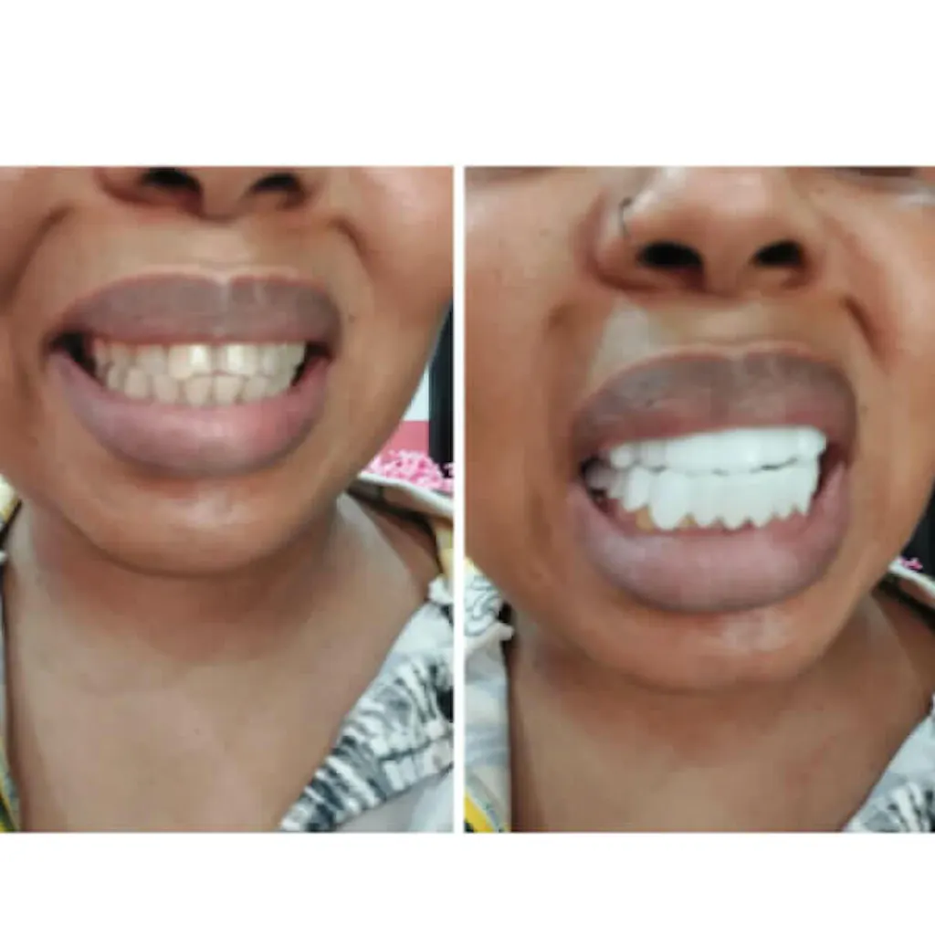 Instant Perfect Smile Upper & Lower Clip/Snap On Veneers for Perfect ...
