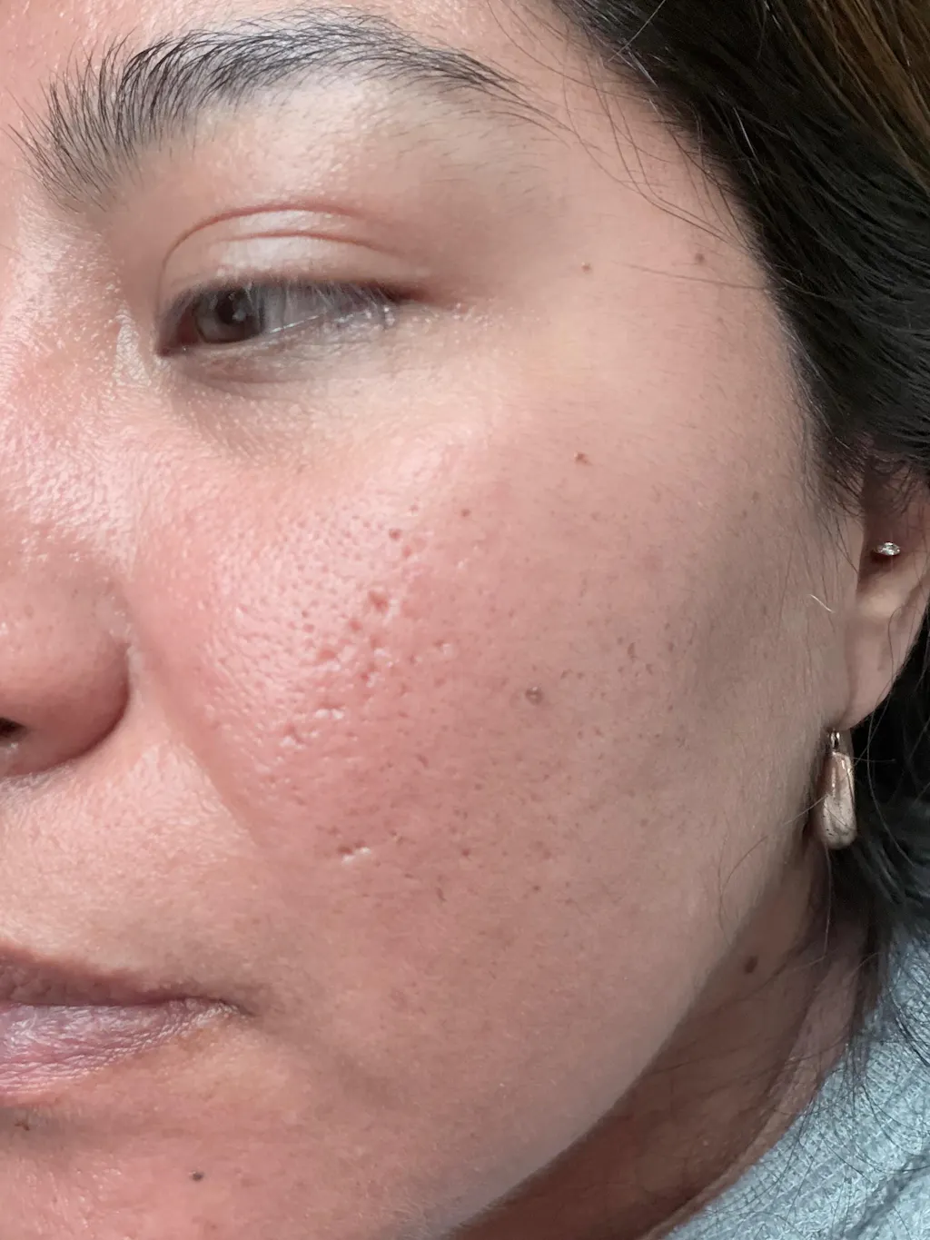 Banish Kit 3.0: Safest Home Microneedling Tool for Acne Scars - up to ...