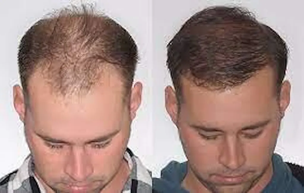 Buy Anti Bald Hair Oil - Reduce Patches & Encourage Hair Regeneration