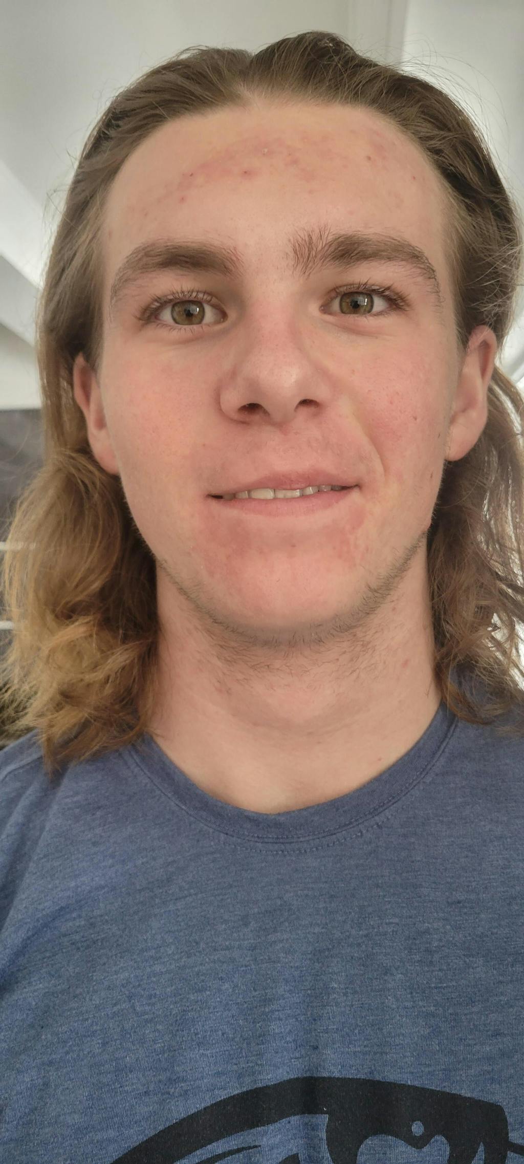 DermaHealer UVB Light Therapy Lamp - treat Psoriasis, Vitiligo at home ...