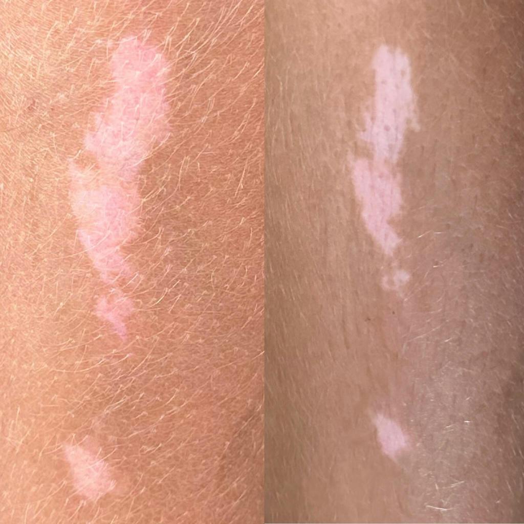 DERMAHEALER（ダーマヒーラー）ハンドヘルド UVB 療法用ランプ – dermahealer.jp