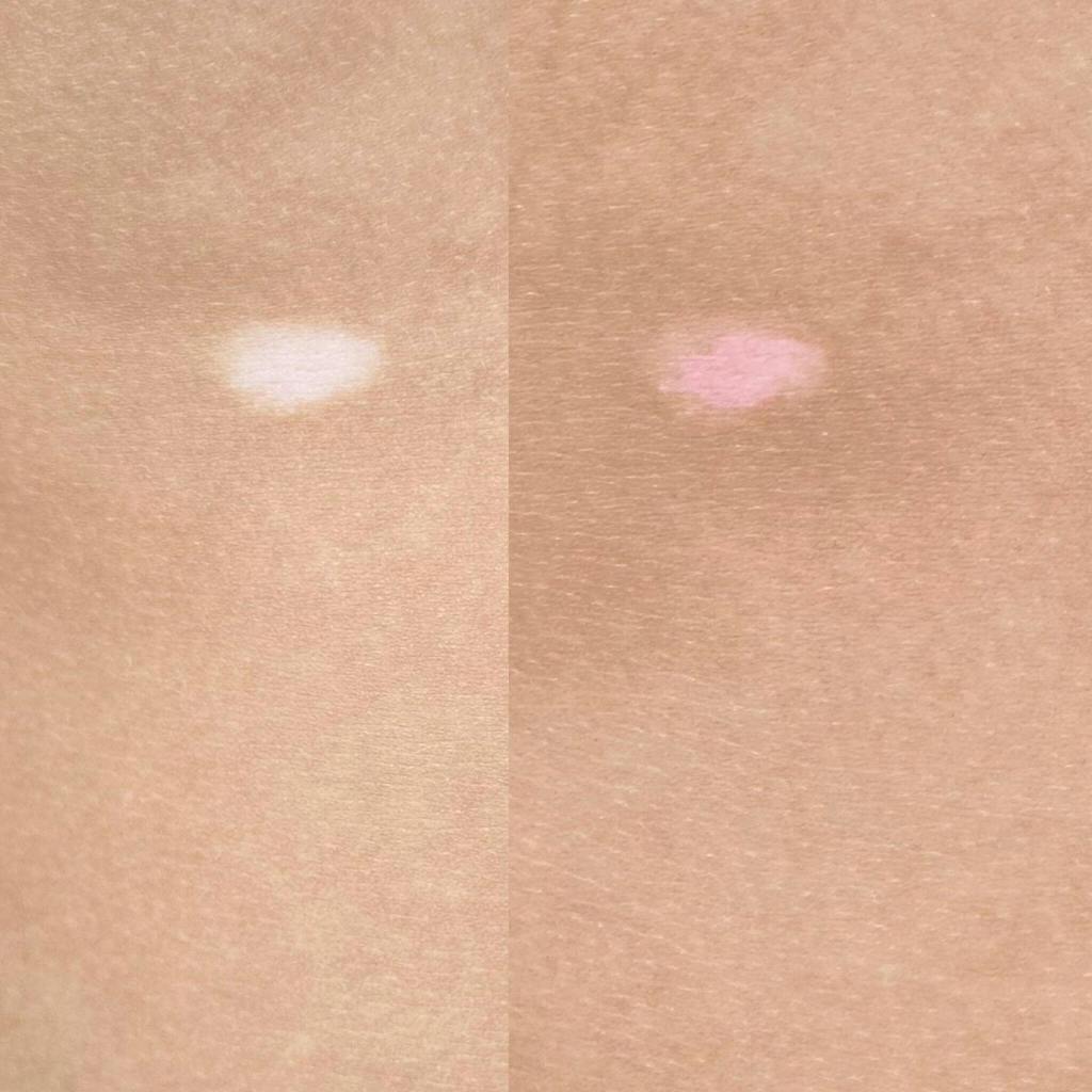 DERMAHEALER（ダーマヒーラー）ハンドヘルド UVB 療法用ランプ – dermahealer.jp