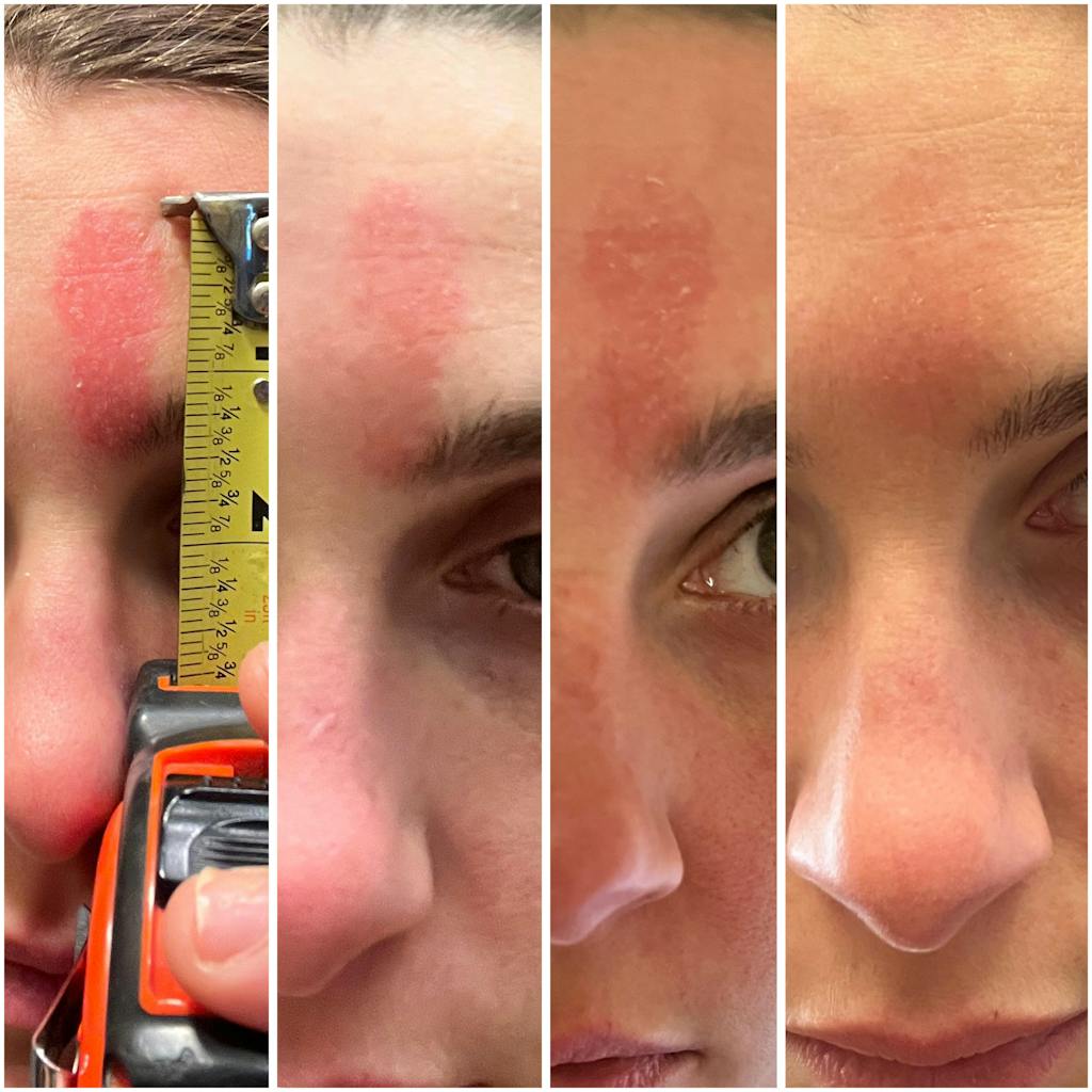 DERMAHEALER（ダーマヒーラー）ハンドヘルド UVB 療法用ランプ – dermahealer.jp