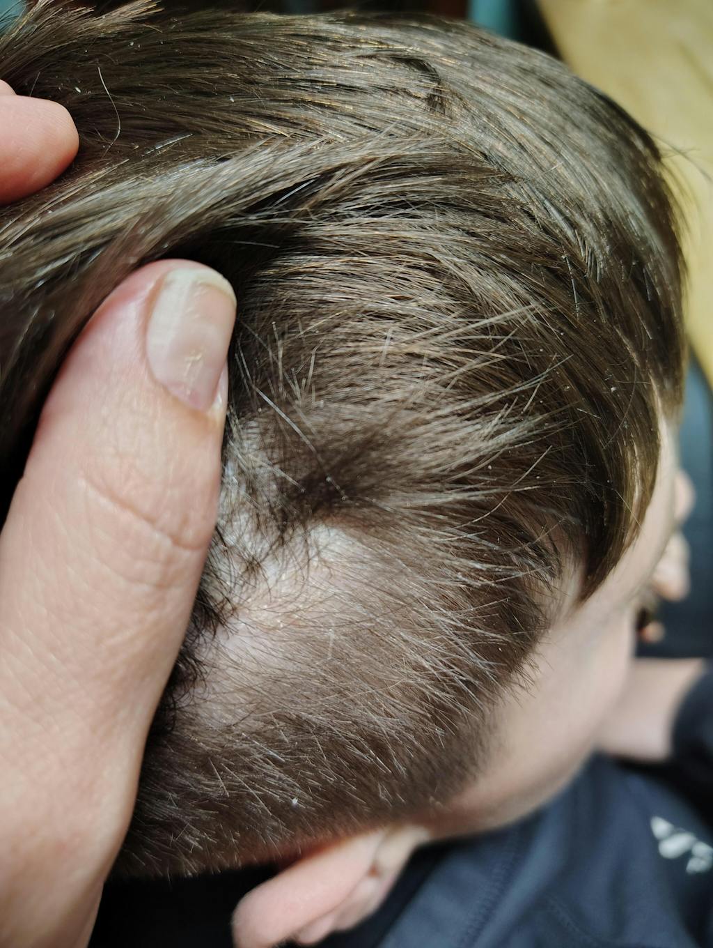 Dermoia Eczema Shampoo and Conditioner – DERMOIA