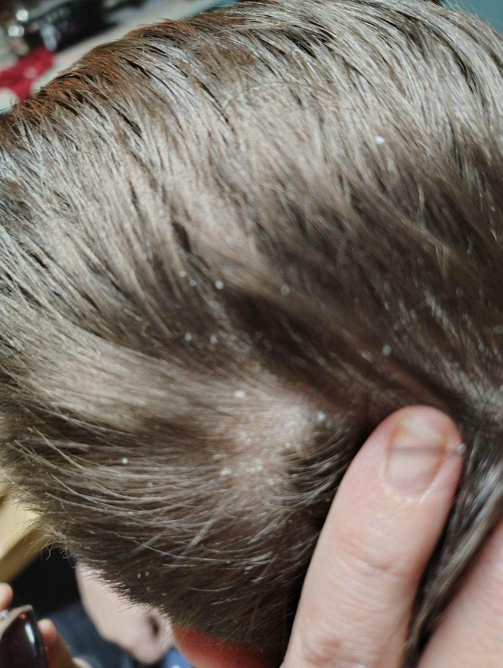 Dermoia Eczema Shampoo and Conditioner – DERMOIA