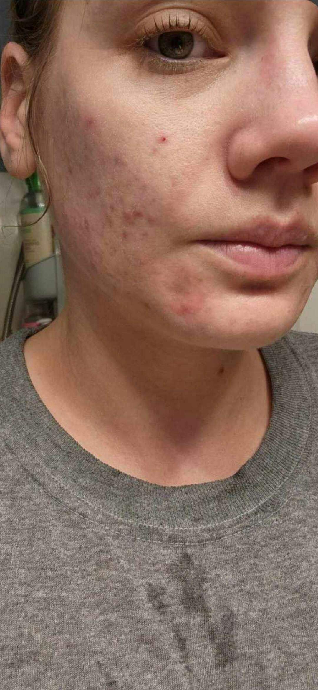Comprehensive Acne System – DRMTLGY