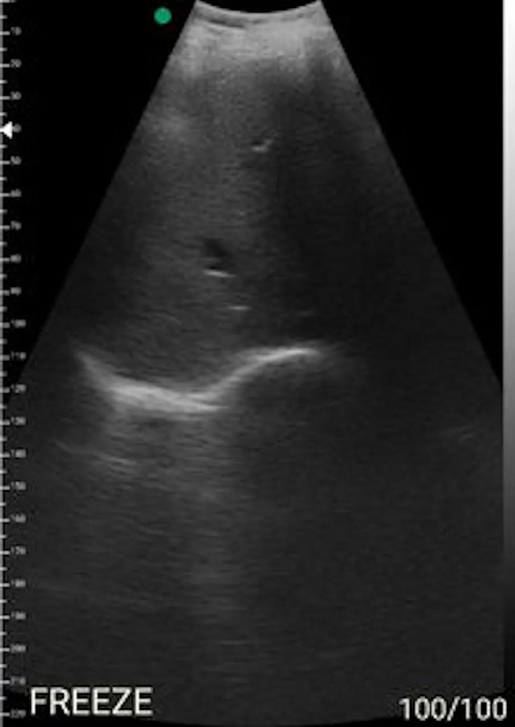 EagleView Portable Wireless Ultrasound Machine with Linear, Convex and ...