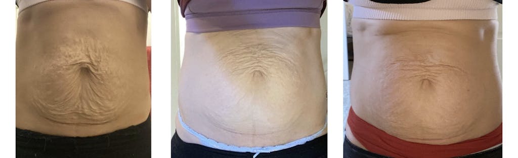 Stretch Marks Derma Roller Kit | Australia's No.1 Dermarolling Shop ...