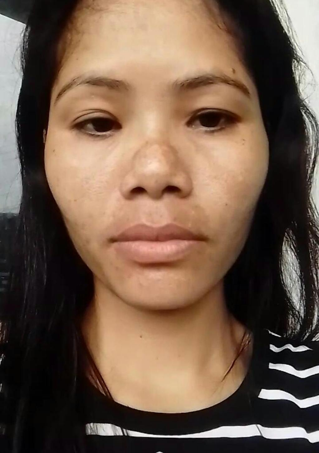 Buy Skarfix-TX | Hyper Pigmentation & Melasma Treatment – Fixderma Skincare