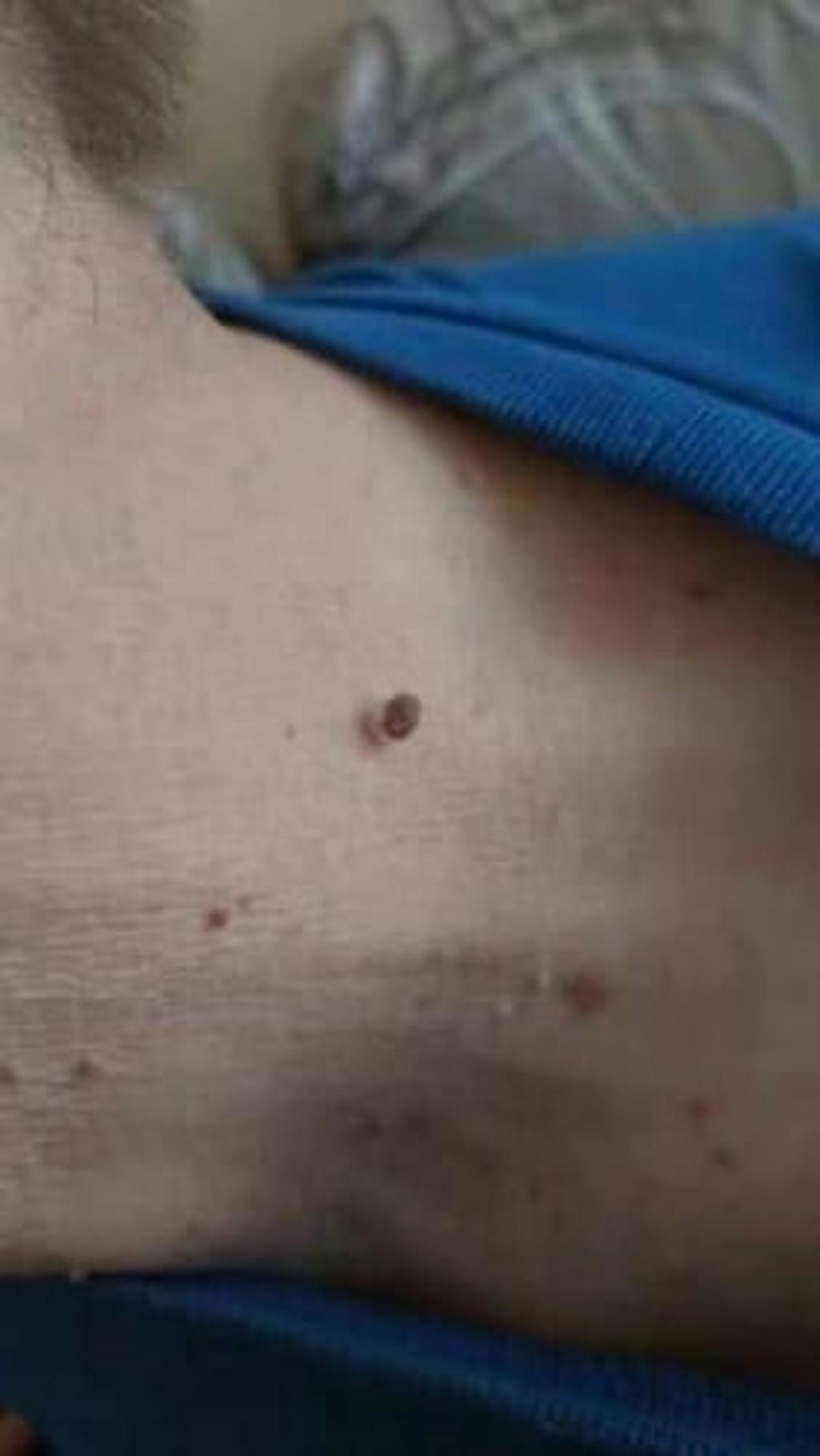 TagBuddy Pro - No More Skin Tags – Glomisk