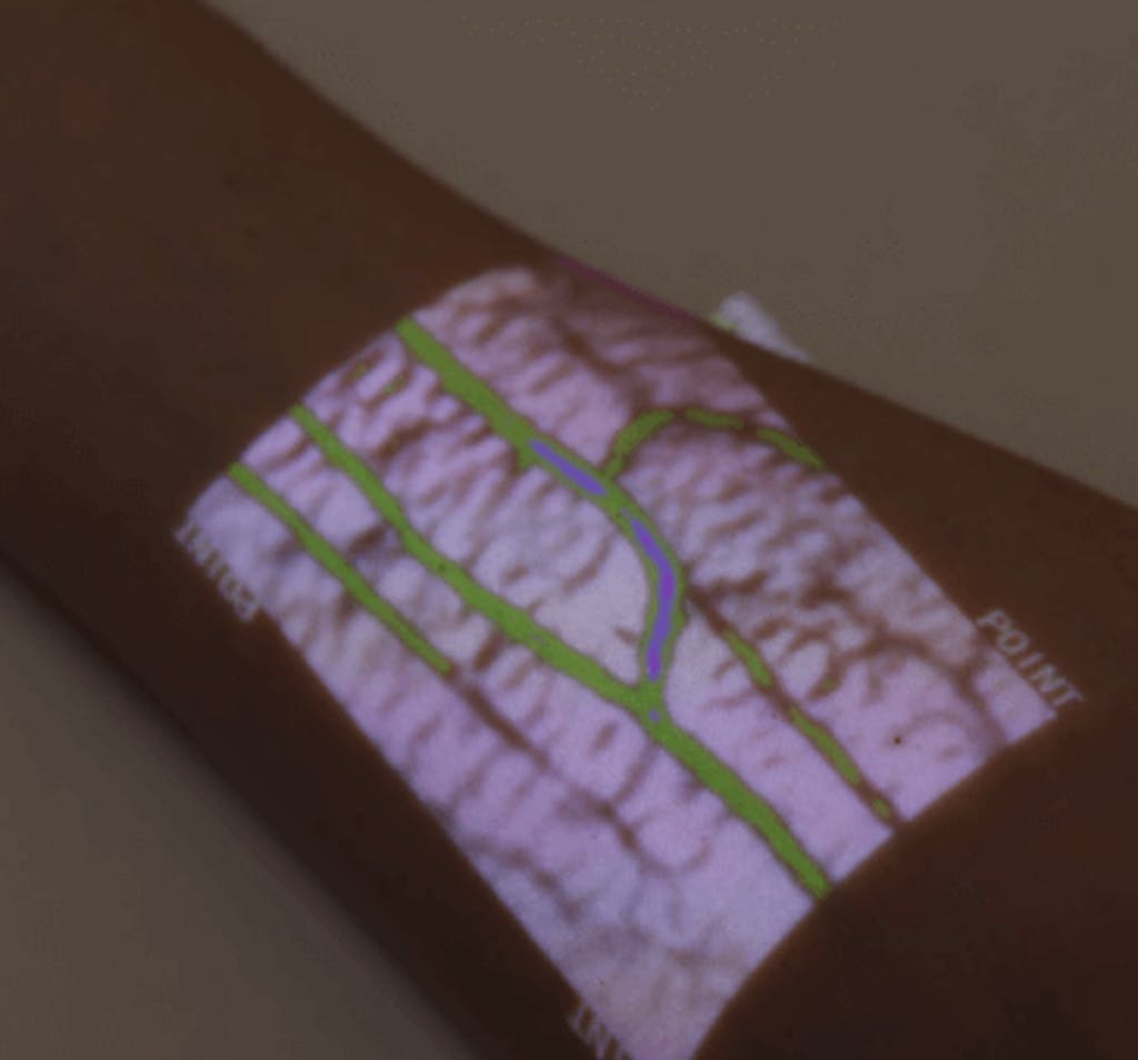 Augmented Reality Lite 2.0 Vein Finder Device