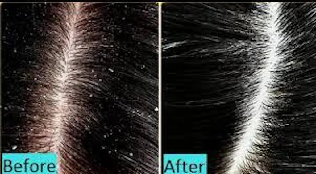 Buy Dandruff Hair Cream to Combat Dandruff & Soothe Itching