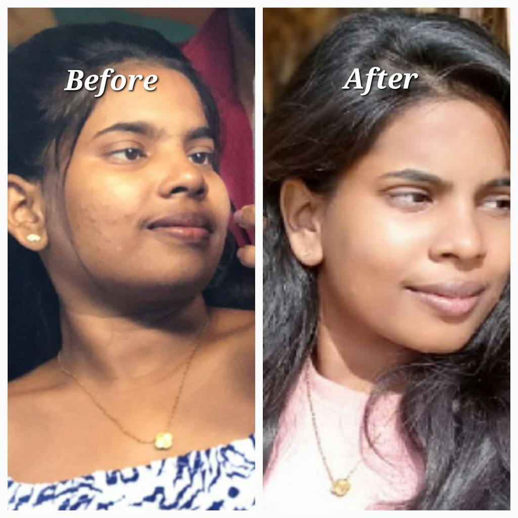 Pimples Out Spearmint No Marks Treatment