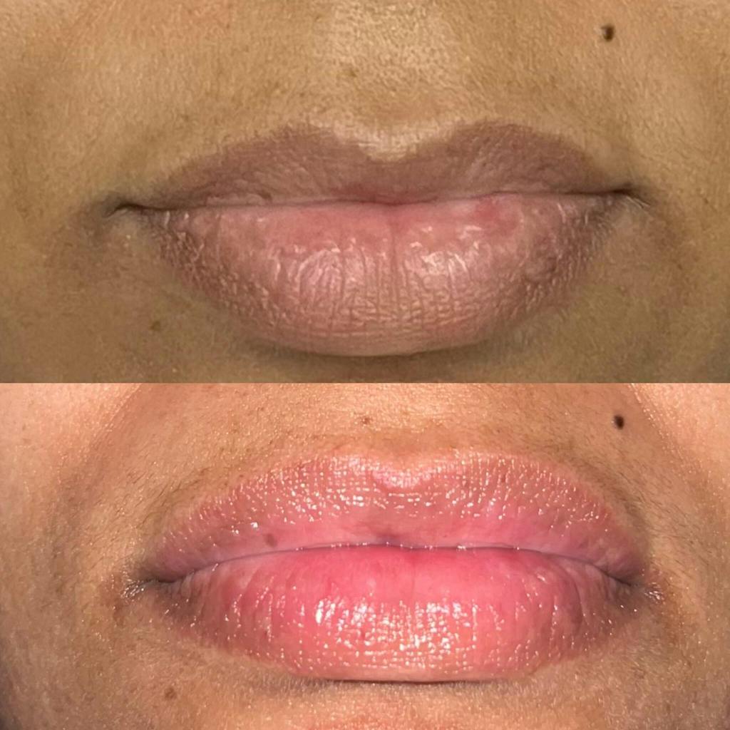 REGENPEN Cartridge Bundle for Daily Skin Repair and Renewal – LORDE AND ...