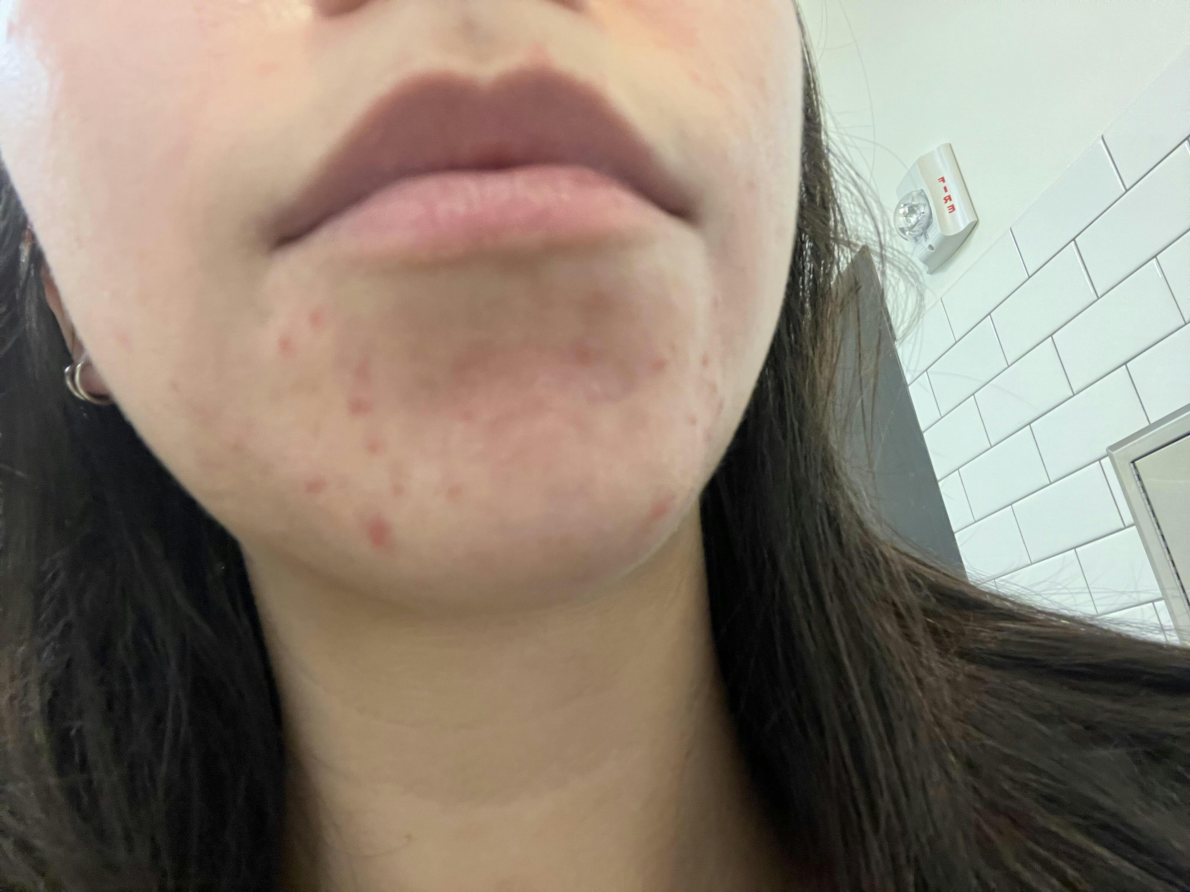 Little Bumps On Cheeks Lupon gov ph little-bumps-on-cheeks-lupon-gov-ph