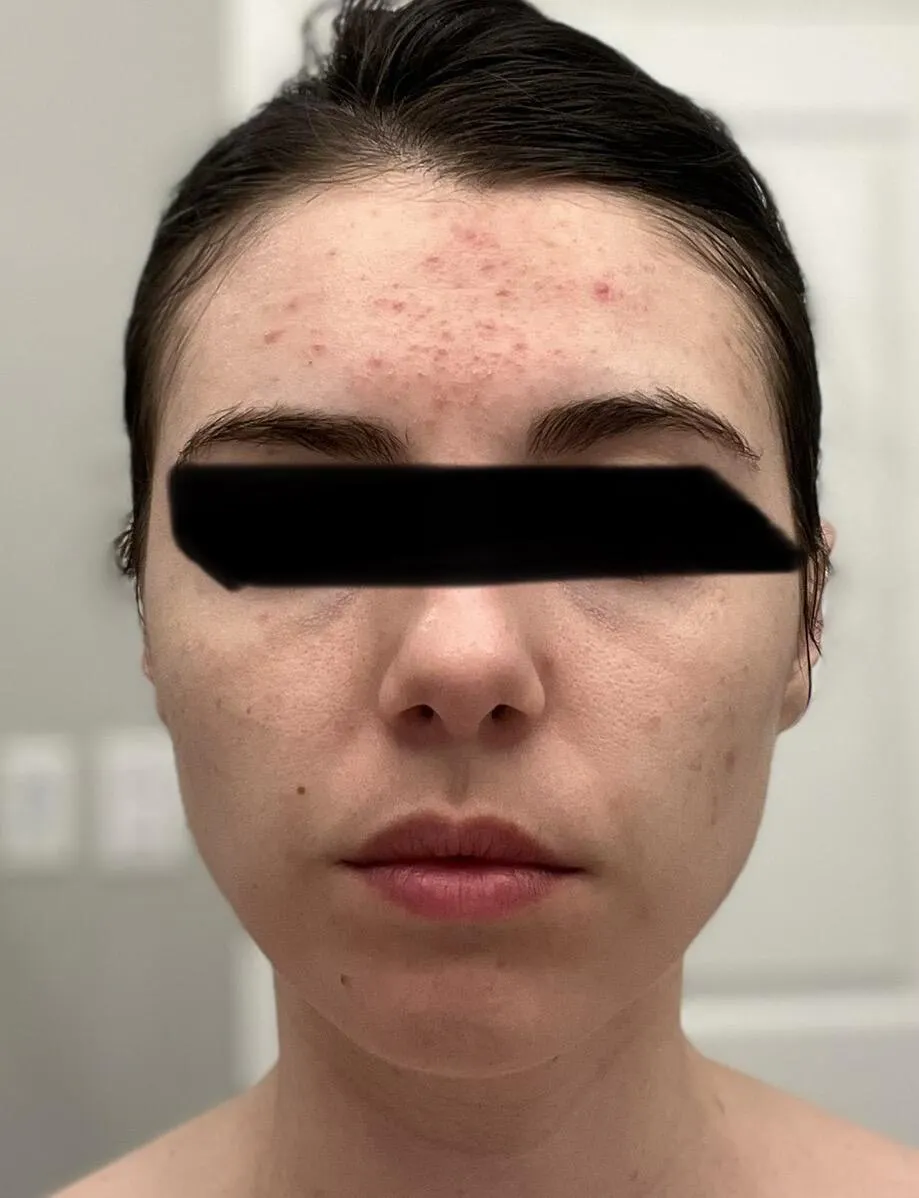 Malezia Acne Treatment Gel | Fungal Acne Safe