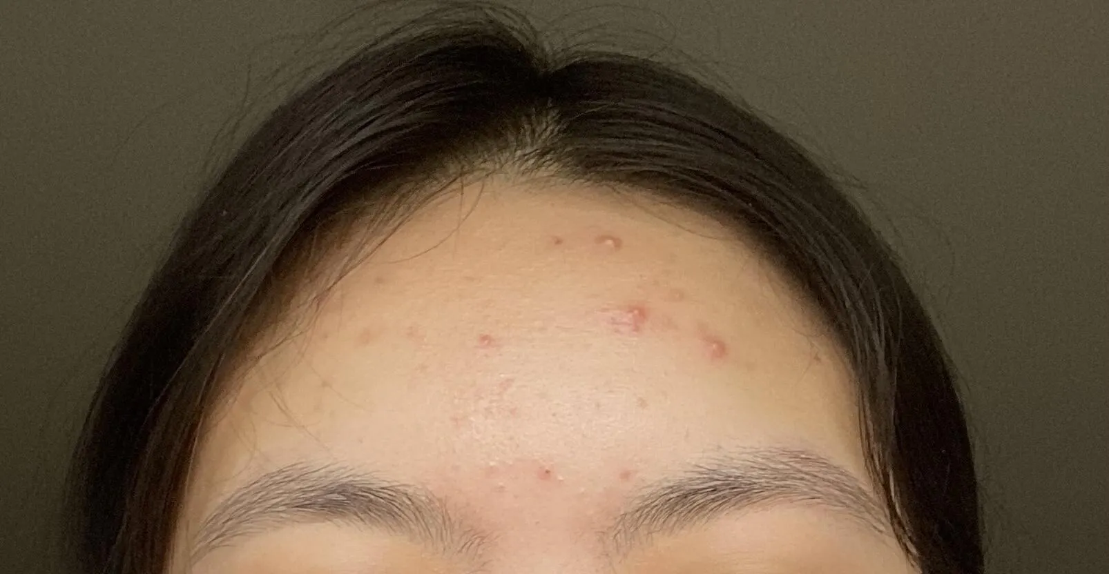 Malezia Acne Treatment Gel | Fungal Acne Safe