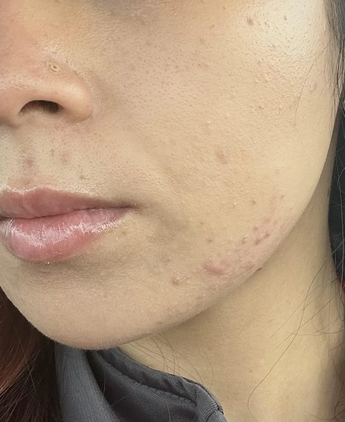 Malezia 5% Urea Moisturizer | Fungal Acne Safe