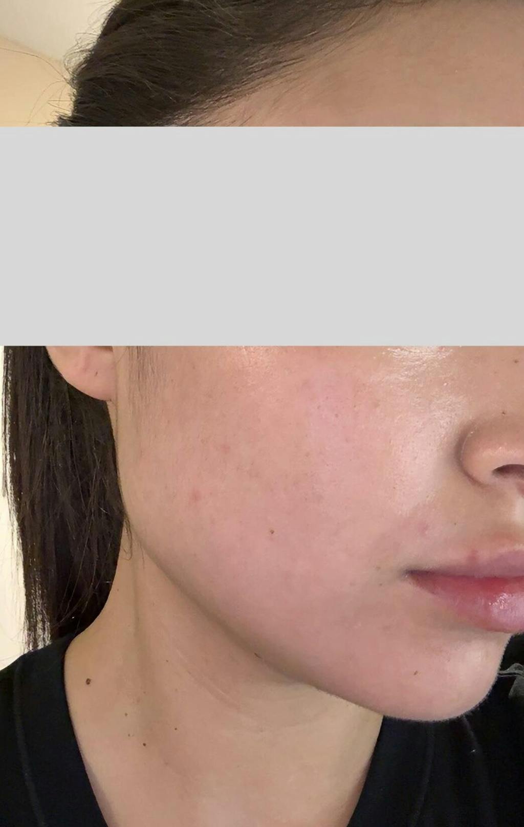 Malezia Acne Treatment Gel | Fungal Acne Safe