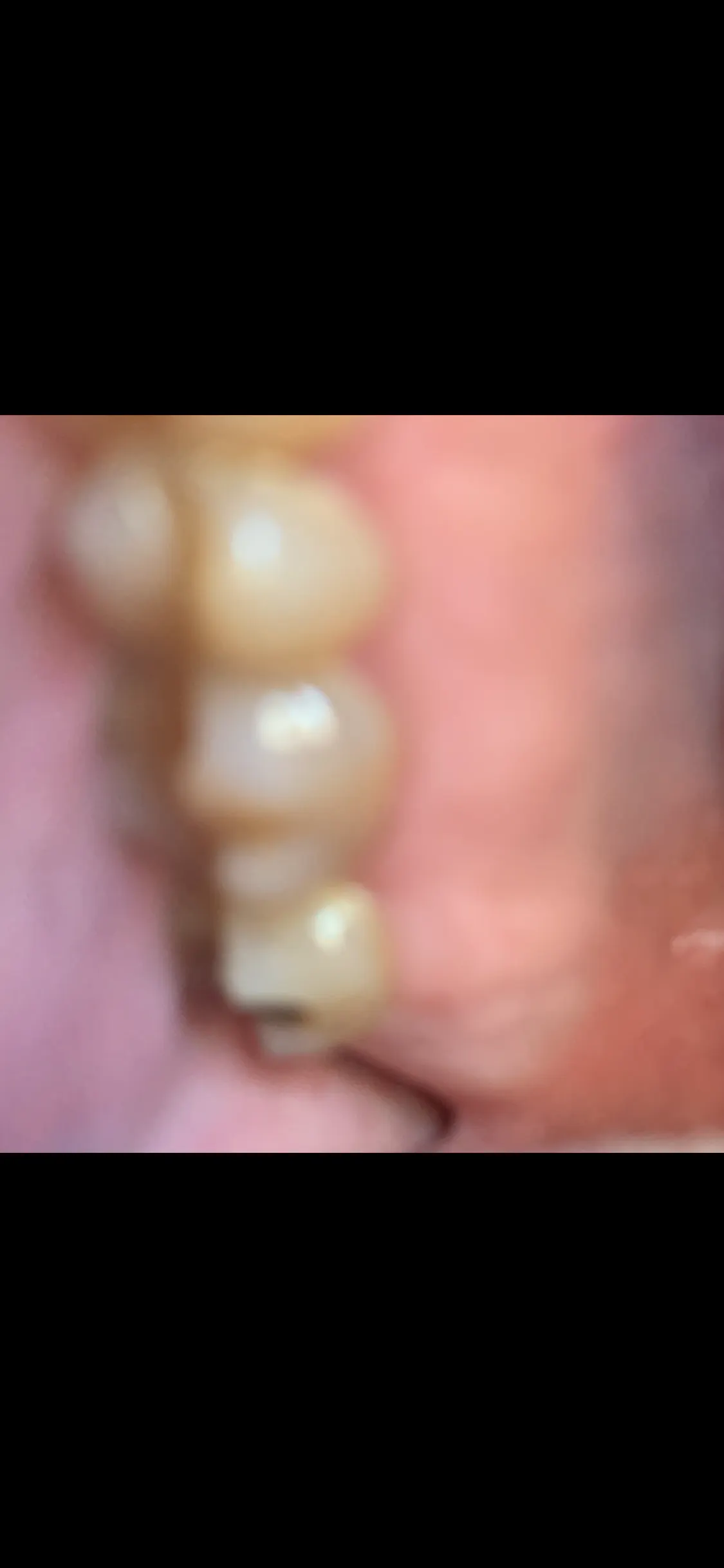 Dentite Tooth Armor – Medicinal Foods