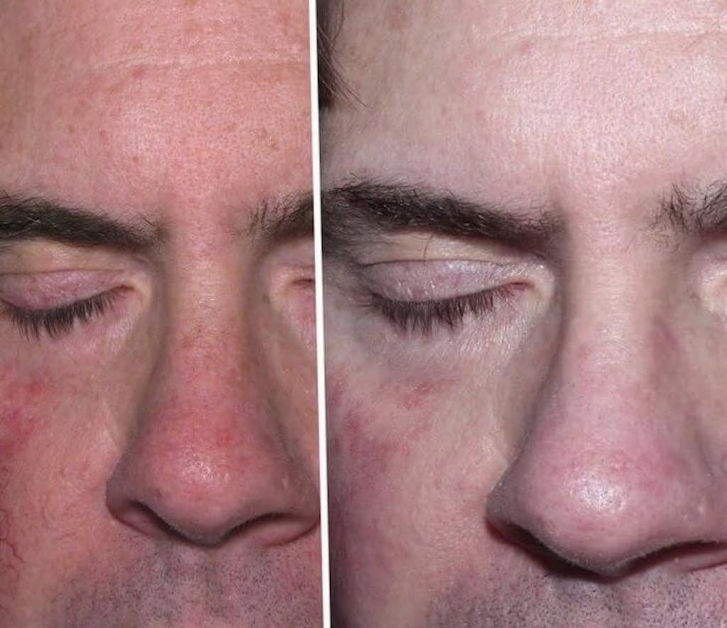 My Sheen Skin Nora LED Light Therapy Face Mask