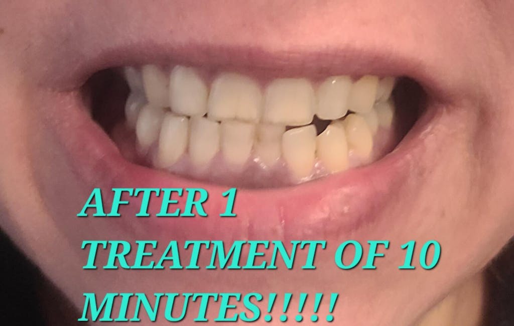 MySmile® Pro Teeth Whitening Kit Brighter Smile in 2 Weeks