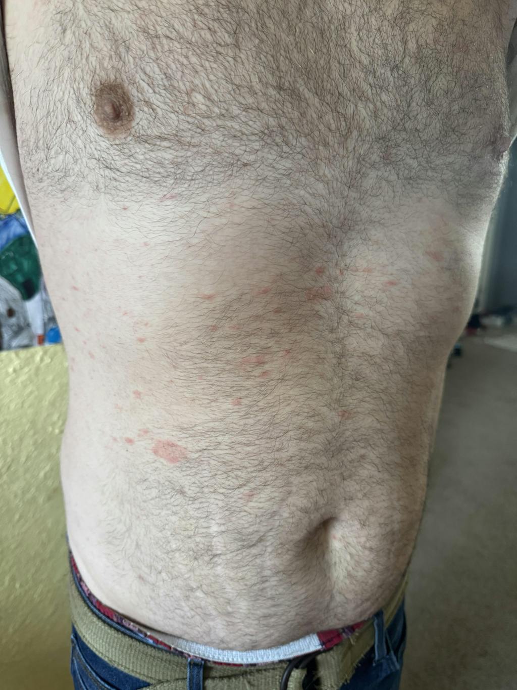 Pityriasis Rosea: Understanding the Christmas Tree Rash | Nature Pure Life