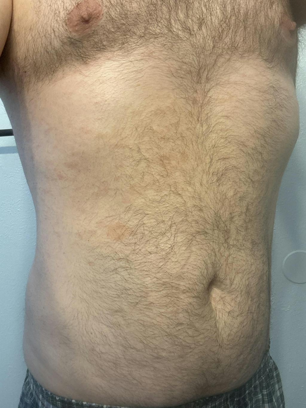 Pityriasis Rosea: Understanding the Christmas Tree Rash | Nature Pure Life