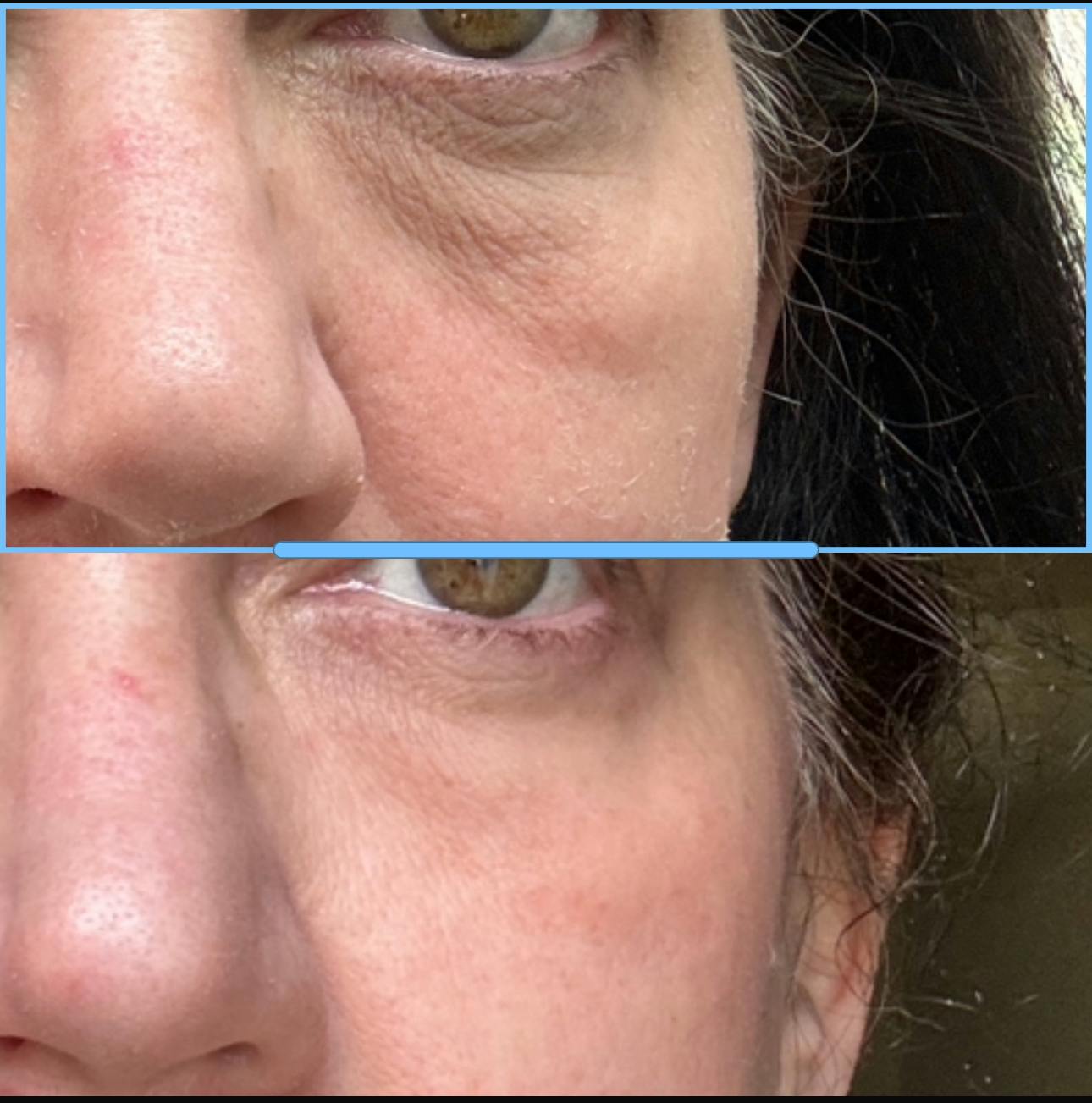 NIRA Pro Laser | Wrinkle Reducing & Skin Tightening Laser Device