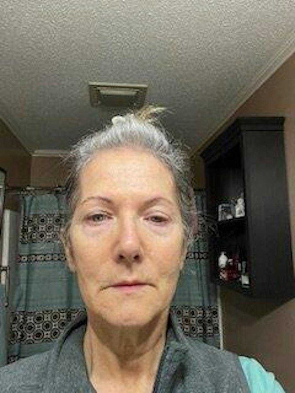 NIRA's Before & After At-Home Laser Results | NIRA Reviews