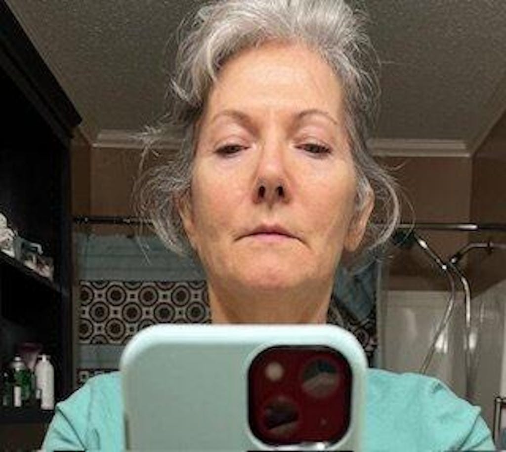 NIRA's Before & After At-Home Laser Results | NIRA Reviews