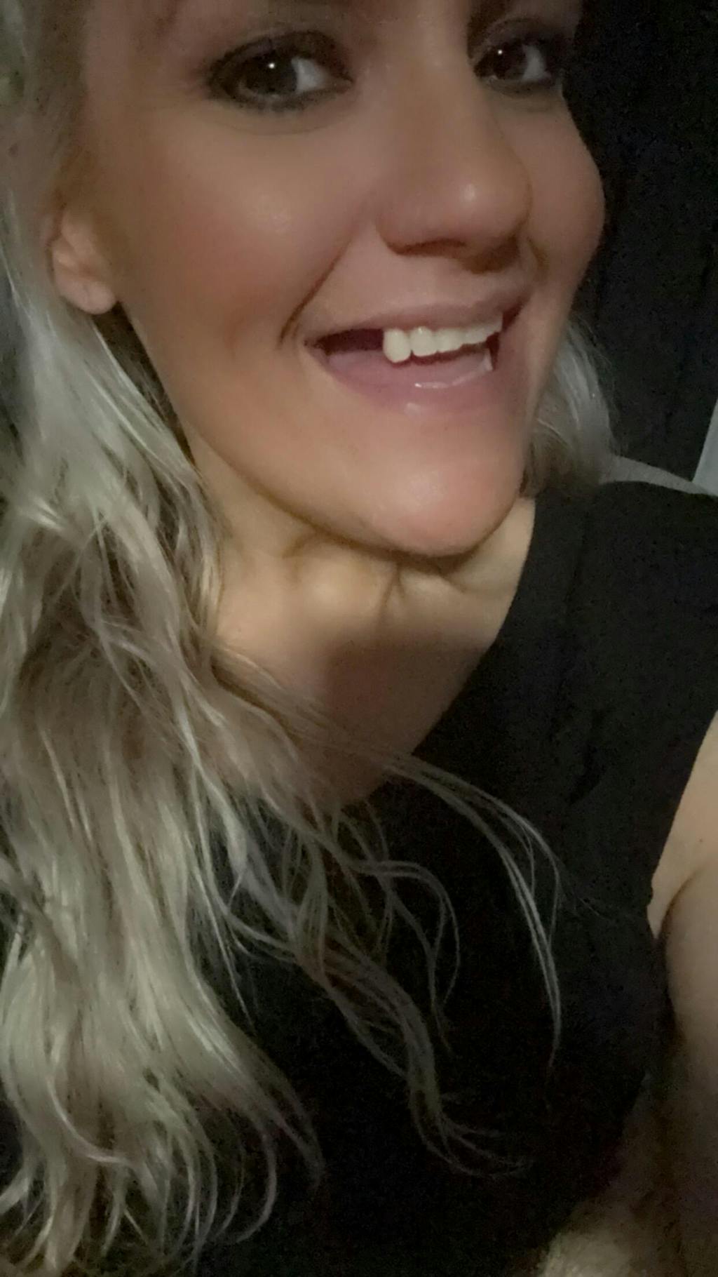 Custom Flipper Stayplate Tooth Acrylic Partial Denture – PatrickDeanDent