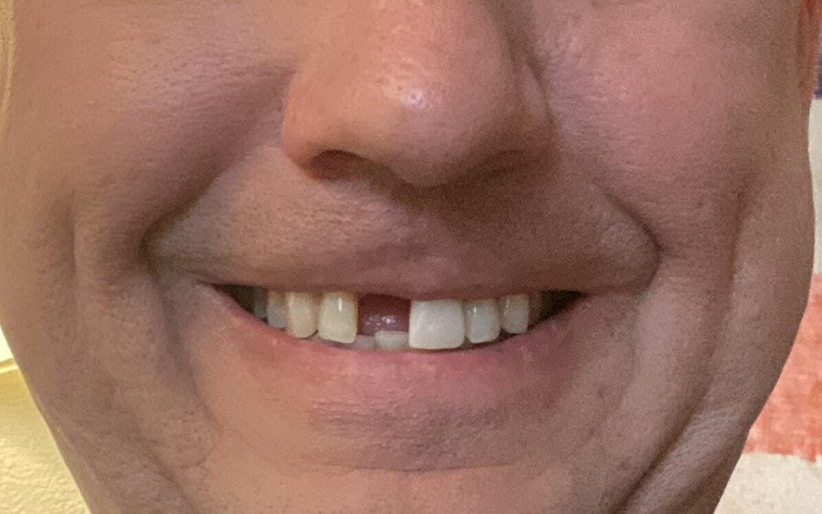 Custom Flipper Stayplate Tooth Acrylic Partial Denture – PatrickDeanDent