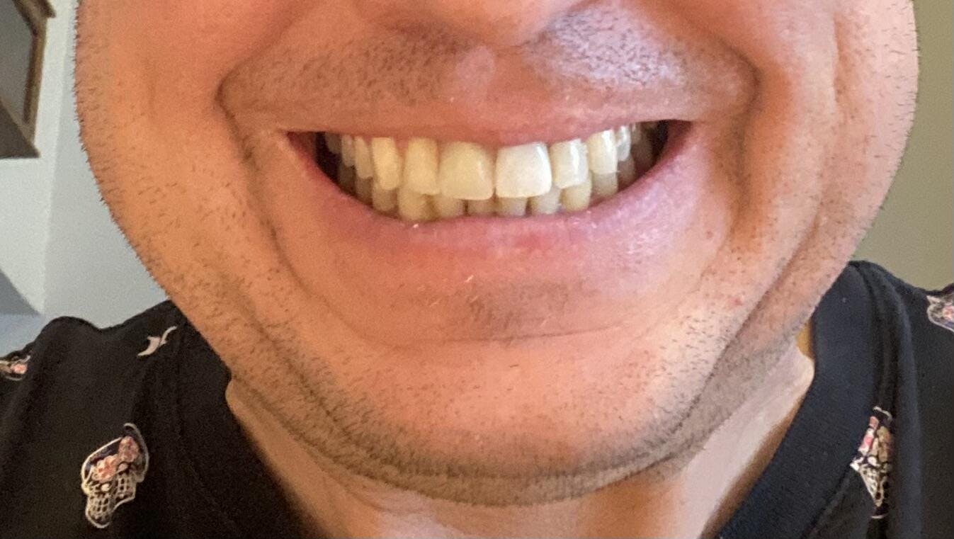 Custom Flipper Stayplate Tooth Acrylic Partial Denture – PatrickDeanDent