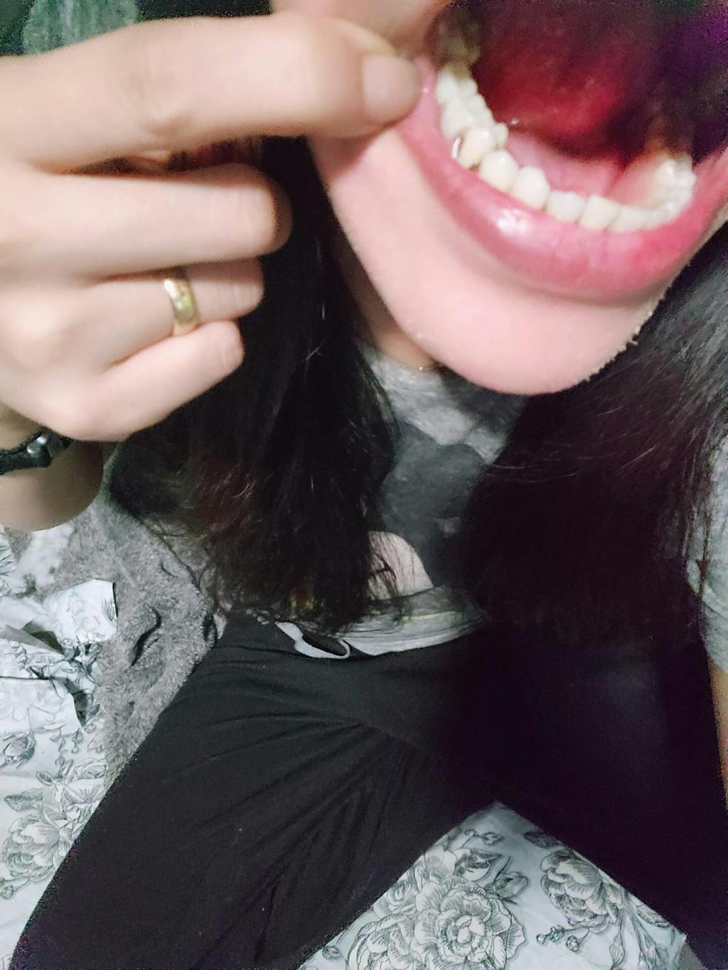 Online Custom Flipper Acrylic Partial Upper Lower Denture – PatrickDeanDent