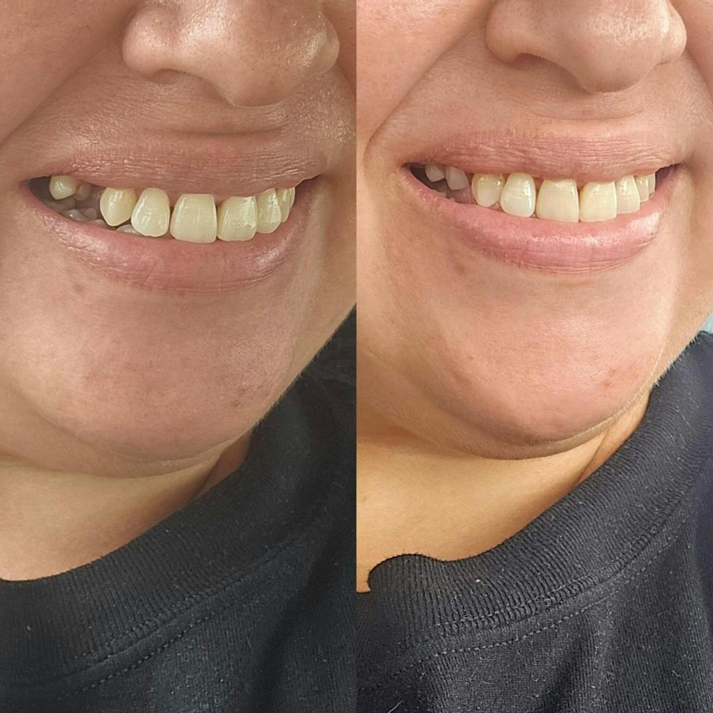 Custom Partials & Full Dentures - Missing Tooth & Teeth Online Denture ...